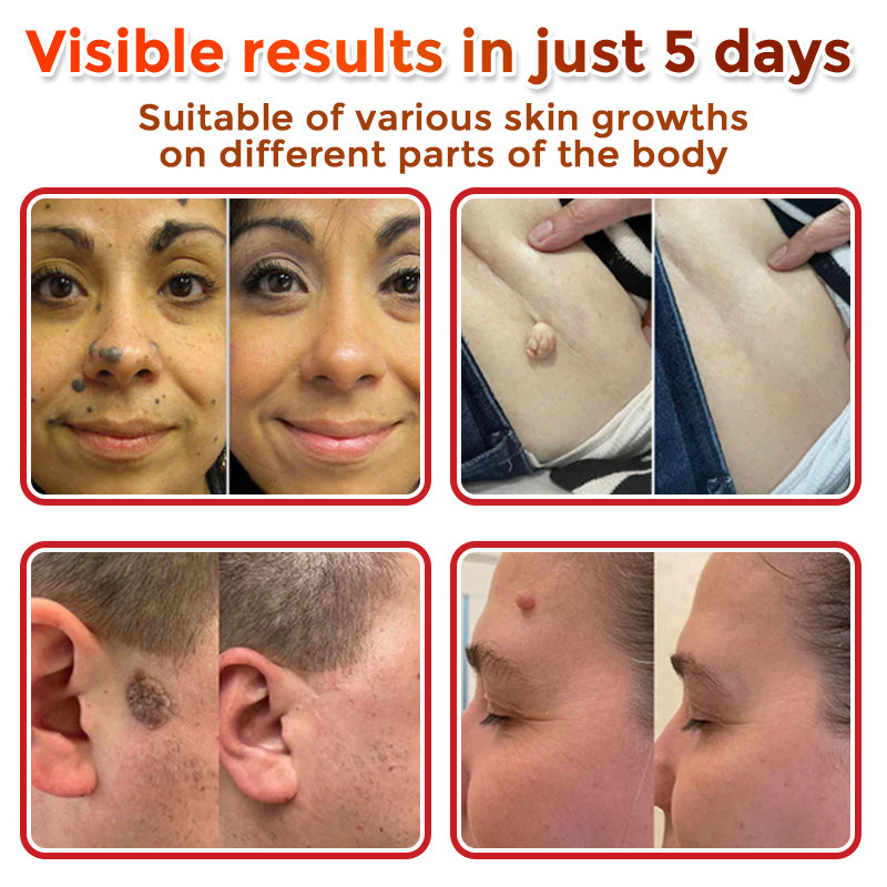 Cvreoz® MicroNeedle Botanic Skin Tag Removal Patch – Aurabeamm
